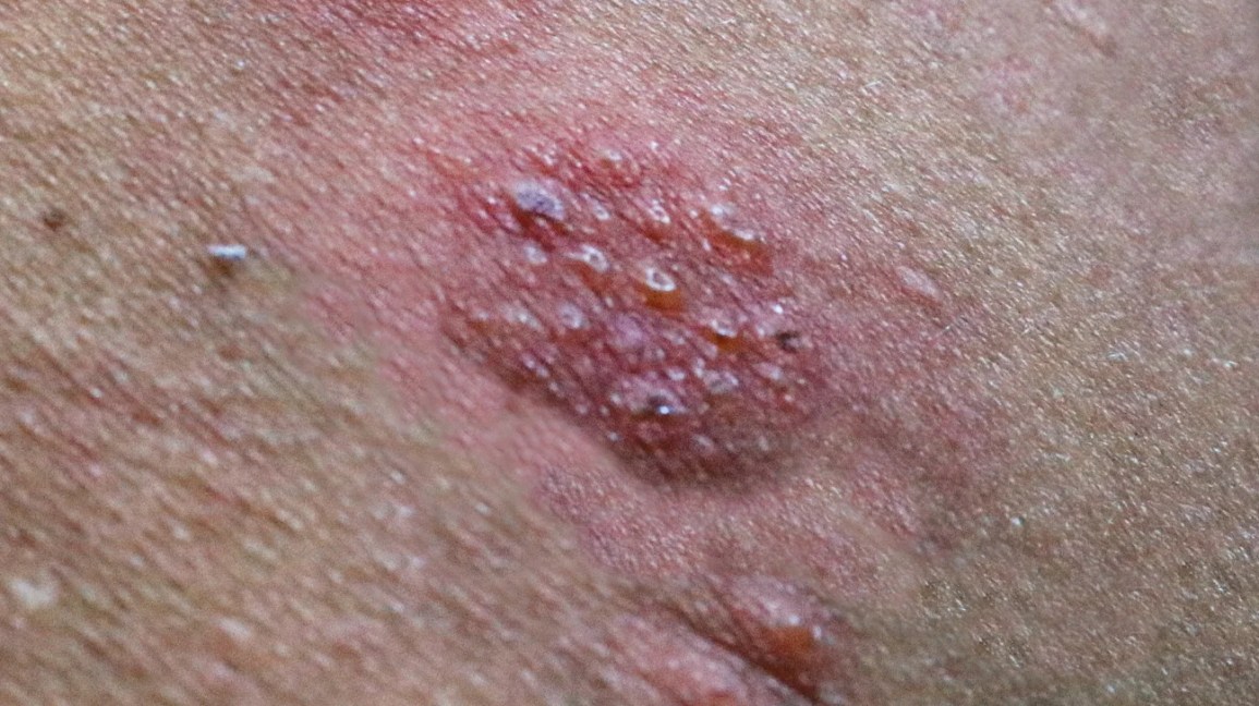 Herpes zoster: vse o pasovcu in noricah – NaDlani.si